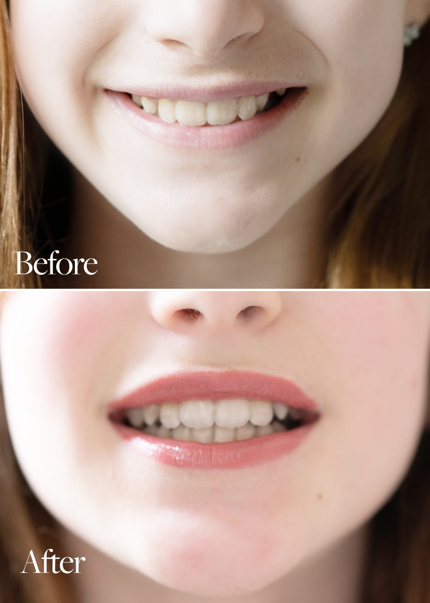 Holiday Ready with Invisalign Treatment… – The Blue Hydrangeas – A ...